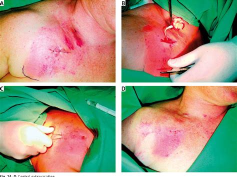 Figure 2 From Case Report Extravasation Of Doxorubicin A Dreaded Complication Of Therapy