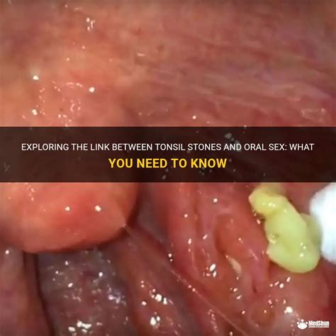 Exploring The Link Between Tonsil Stones And Oral Sex What You Need To