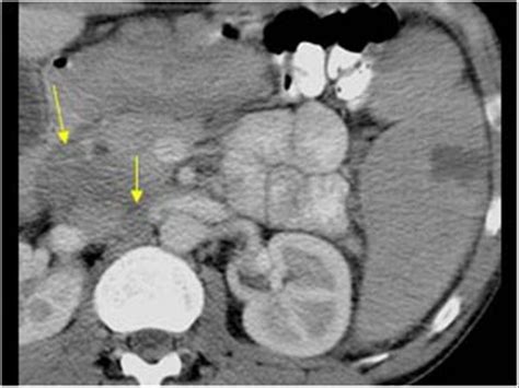 Abdomen And Retroperitoneum 17 Peritoneum Mesentery And Omentum Case 172 Mesenteric Lymph