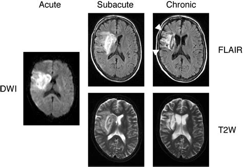 Age Of Infarct Mri Radiology At Stefanie Norton Blog
