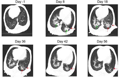 Idiopathic Pulmonary Fibrosis Ipf Model Research Gene Therapy Idiopathic Pulmonary Fibrosis