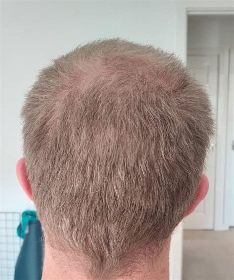 Hair Loss Transplant Advice Hair Loss Forum Hair Transplant Forums