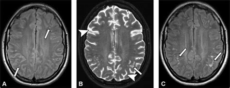Antinmda Receptor Encephalitis Radiographics