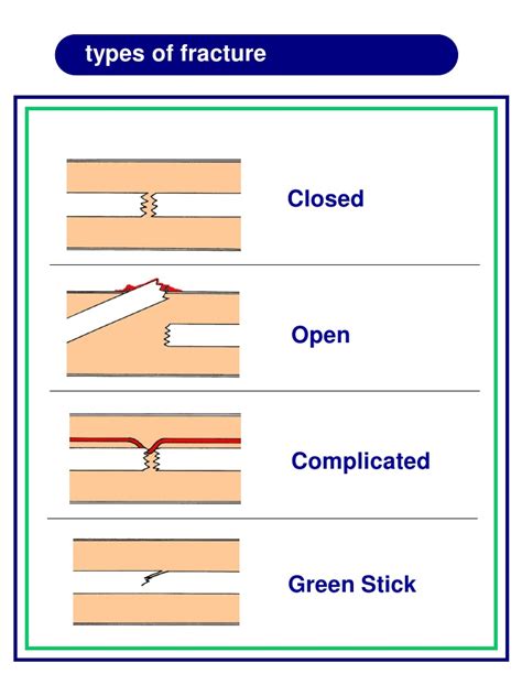 Open V Closed Fracture Learningtaste