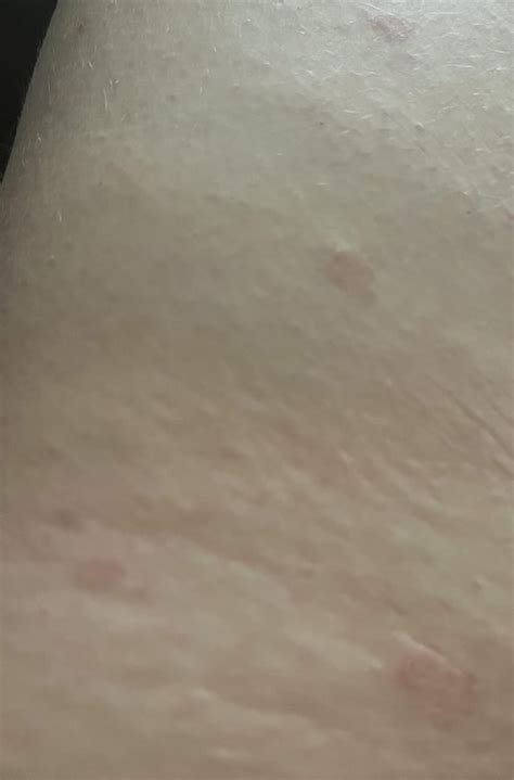 Red Welts All Over Body Rdermatologyquestions