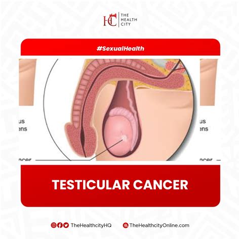 Anatomy Of Testicular Cancer 528 Best Fitness Exercise Images On