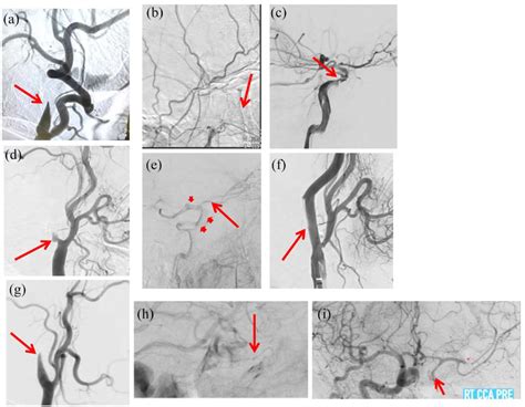 Digital Subtraction Angiography Pseudo Versus True Occlusion Of The Download Scientific