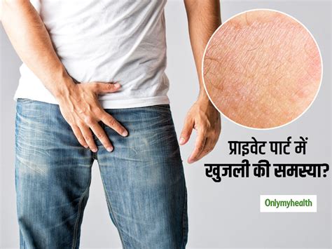 Difference Between Diaper Rash And Jock Itch At Cristopher Robertson Blog