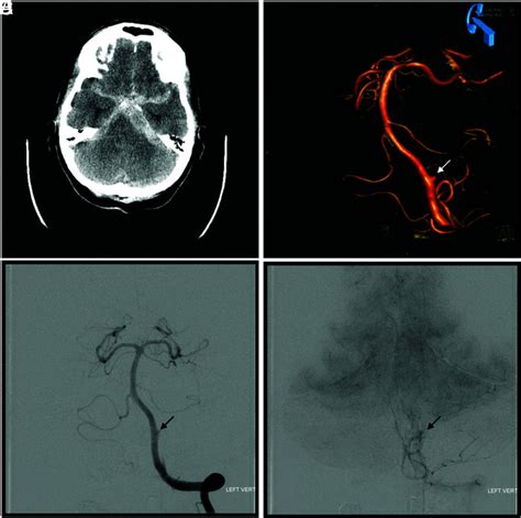 Ruptured Intracranial Aneurysms Treated With The Pipeline Embolization