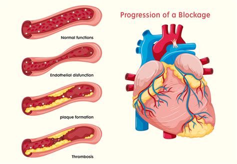 Symptoms Of Heart Blockage You Should Never Ignore