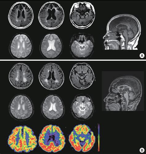 Table 1 From Two Cases Of Non Fluent Variant Primary Progressive Aphasia With Different