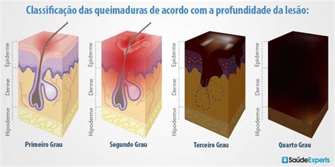 Graus De Queimaduras 2 Nutrição