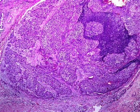 Metastasis Of Carcinoma To Lymph Node Light Micrograph Stock Image
