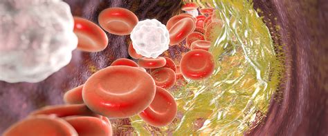 Familial Hypercholesterolemia Treatment Guide