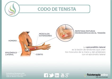 Dolor De Codo Qué Es Causas Síntomas Tratamiento Y Consejos