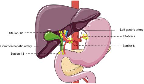 The Lymph Node Dissection Map Of Patients With Suspected Positive Lymph Download Scientific
