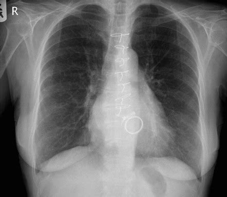Heart Valve Replacement Xray