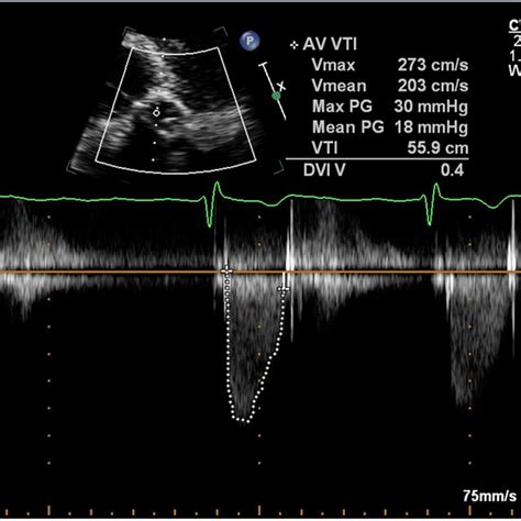Transthoracic Echocardiogram January 2018 Continuous Wave Doppler In Download Scientific