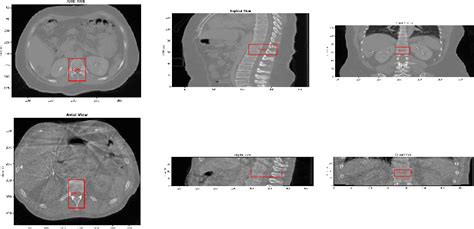 An Improved 3d Region Detection Network Automated Detection Of The 12th Thoracic Vertebra In