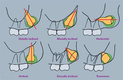The Maxillary Third Molar Pocket Dentistry
