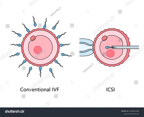 Contrasting Conventional Vitro Fertilization Ivf Intracytoplasmic Stock Vector Royalty Free