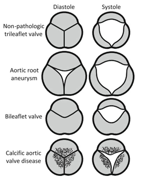 Valve Geometry Types Left Tricuspid Right Bicuspid Top Complete