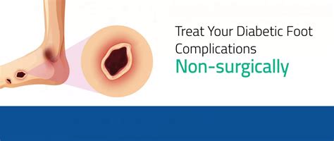 Arterial Embolisation Aster Arterial Embolisation Aster