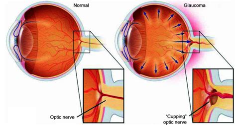 Glaucoma In Adults Diagnosis Management And Prediagnosis To End Stage