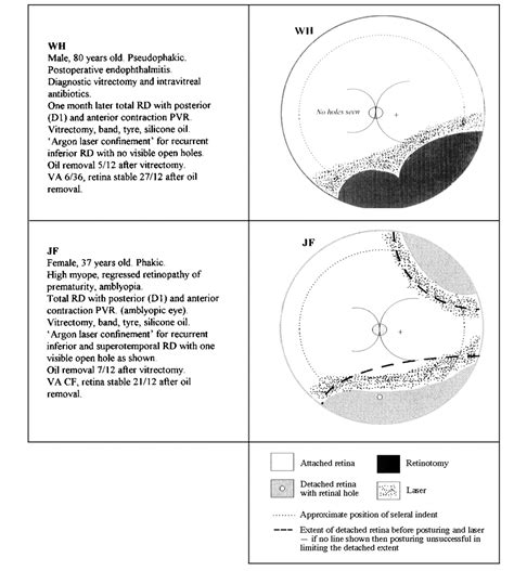 Vitrectomy Before And After