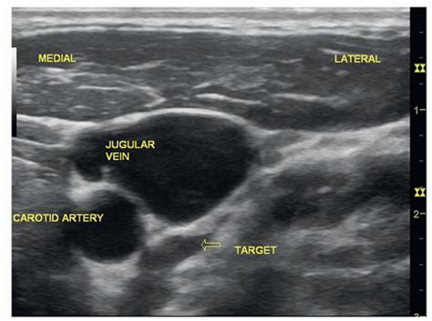 Ultrasound Guided Pectoral Plane Nerve Block—pecs Ii Anesthesia Key