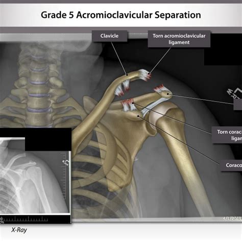 Medical Legal Exhibits Legal Animations And Trial Graphics
