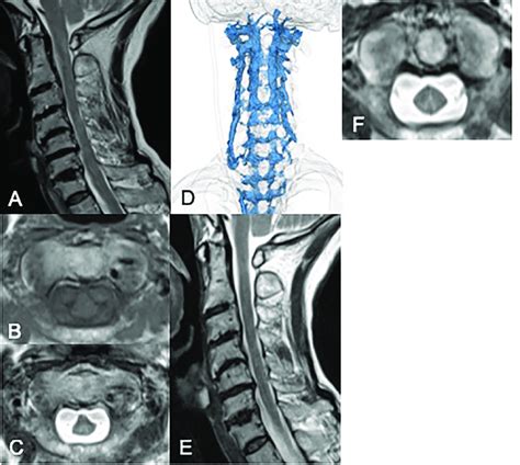 Case 2 Sagittal T2 Weighted A And Axial T1 T2 Weigthed B And C