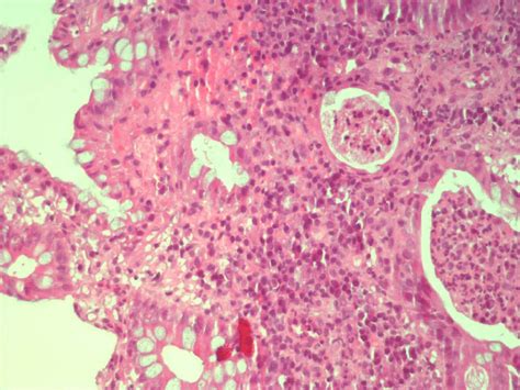 Ulcerative Colitis Humpathcom Human Pathology