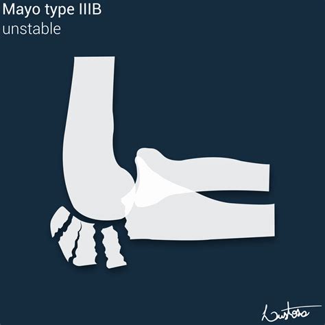 Mayo Classification Of Olecranon Fractures Image Mayo Classification Of Olecranon Fractures Image