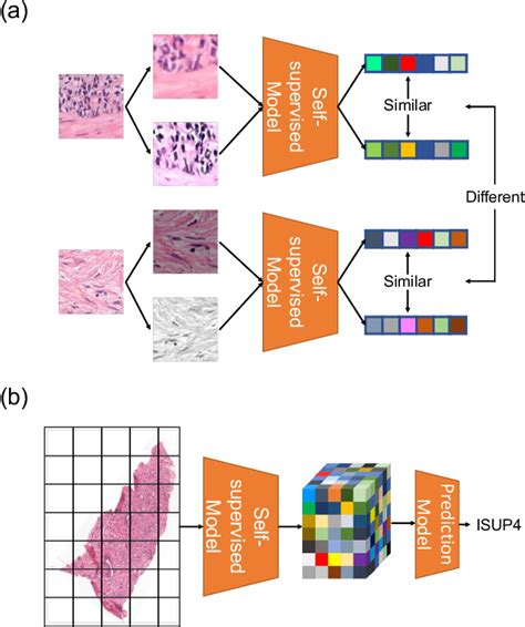 Grading Of Prostate Whole Slide Images Using Weak Self Supervised