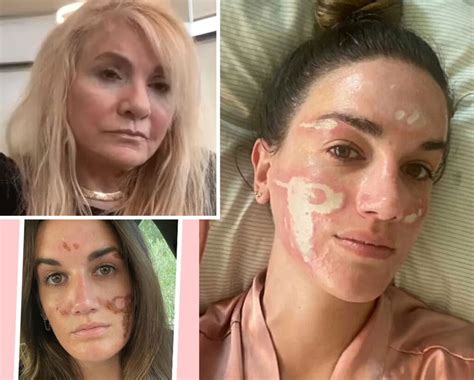 Celebrity Facialist Accused Of Permanently Scarring Womans Face