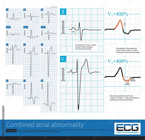 Sometimes We Can Use Lead V1 To Measure The Interval And Amplitude Of P Wave And