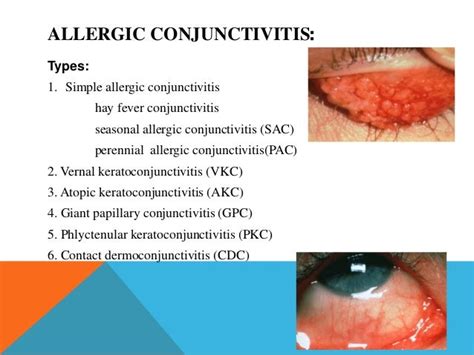 Allergic Conjunctivitis