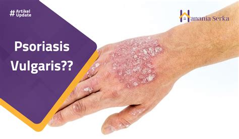 Psoriasis Vulgaris Hanania Serka