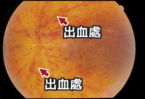 季節交替溫差大 小心眼中風 自由健康網