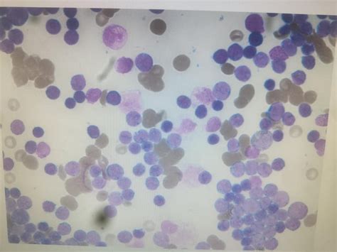 Reactive Plasmacytoid Lymphocytes Vs Plasma Cells Whats The Difference R Hematology
