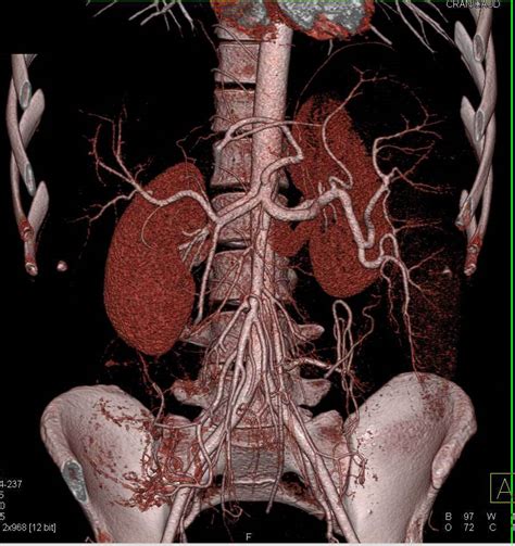 Ulcerating Gastric Gist Tumor Stomach Case Studies Ctisus Ct Scanning Ulcerating Gastric Gist Tumor Stomach Case Studies Ctisus Ct Scanning