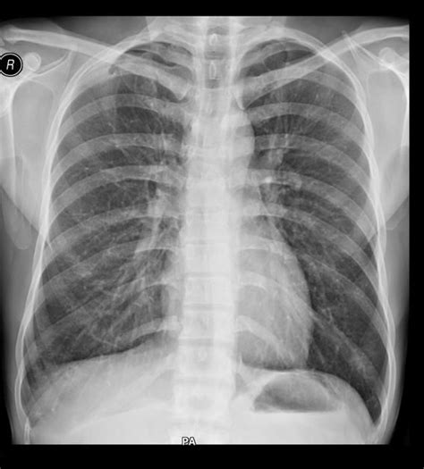 Pseudoarticulation Of Rib Radiology Case Radiology Medical Radiography