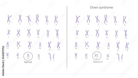 Vecteur Stock The Chromosome 21 Are Changed The Copy Number From Normal