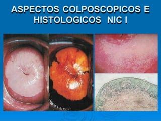 Cancer De Cervix Pptx