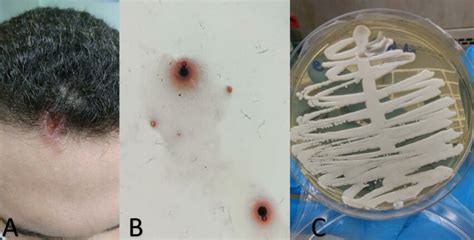 Skin Lesion Blastoconidias And Growth Of Cryptococcus Neoformans Download Scientific Diagram