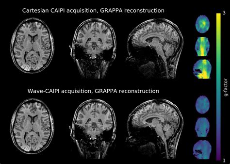 Grappa Reconstructed Wave Caipi Mp Rage Skope