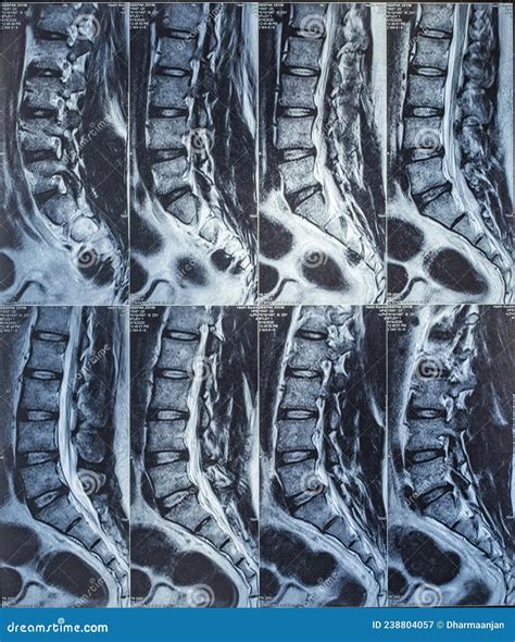 Lumbar Spine Mri Bulging Disc