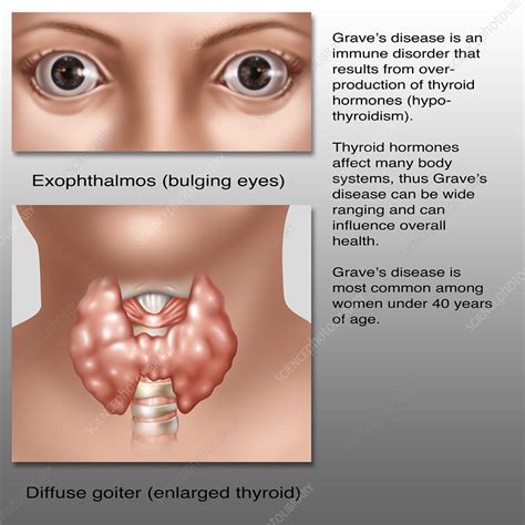 Exophthalmos Thyroid