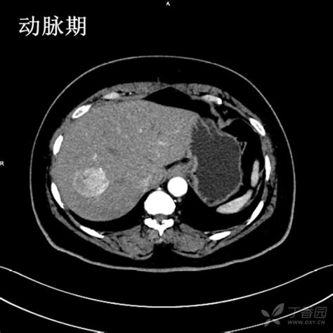 小肝癌ct表现 普通外科讨论版 丁香园论坛